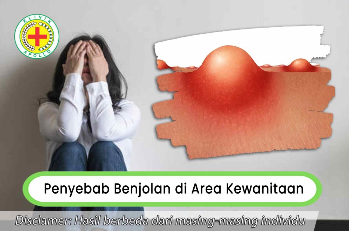 Pentingnya Pemahaman! 7 Penyebab Benjolan di Area Kewanitaan | Klinik ...